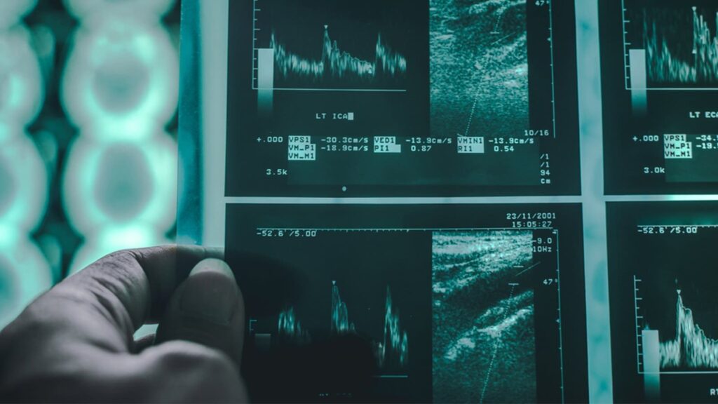 Carotid Duplex Ultrasound - A&B Neurology